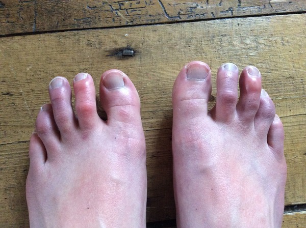 What's wrong with my toes? Any ideas would be greatly appreciated ...