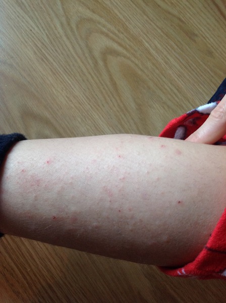 Itchy skin on DS legs and knee, scratching ...what could this be ...