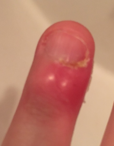 Infected finger waiting for it to pop, pics included | Mumsnet