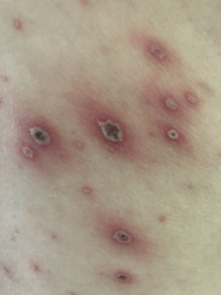 infected chicken pox??? help!!! please | Mumsnet