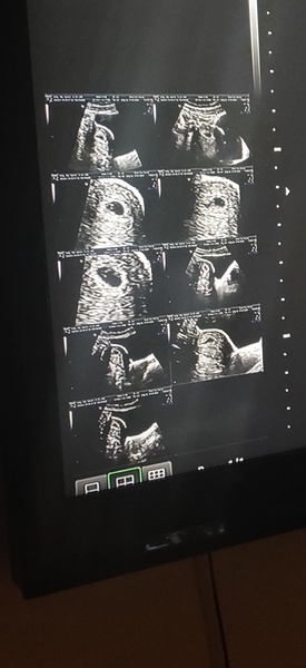 Early Scan - is it twins ?? | Mumsnet