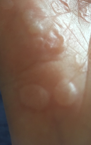 Warning - gross foot blister | Mumsnet