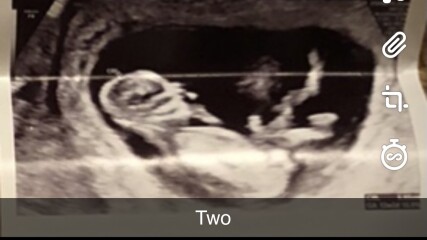 13 weeks nub theory boy/girl | Mumsnet