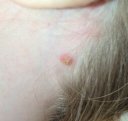*PHOTO WARNING*Do these look like normal chicken pox? | Mumsnet
