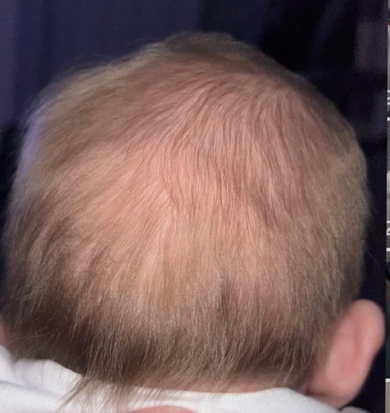 Red Rash On Back Of Baby s Head Under Hair At Alan Rayl Blog Red Rash On Back Of Baby s Head Under Hair At Alan Rayl Blog