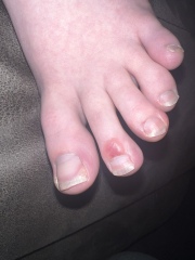 Chilblains? * warning feet photos * | Mumsnet