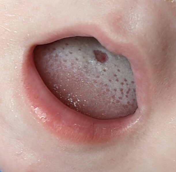 Round Spot On Child s Tongue At Billie Barker Blog