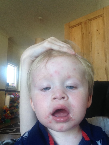 To ask how do you know if chicken pox is infected? | Mumsnet