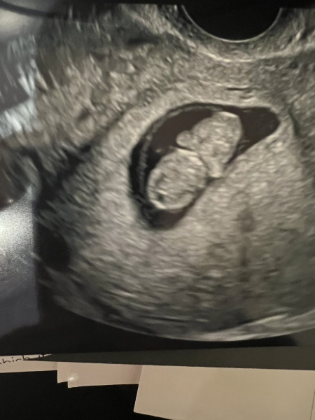 Pregnancy scan images 8/9 weeks | Mumsnet