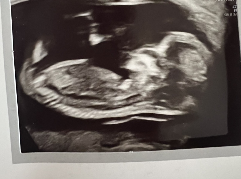 What do you think my baby is from 20 week scan? | Mumsnet