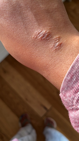 Weird rash - can anyone recognise this and suggest what I can try ...