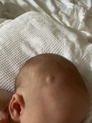 Soft squashy lump on baby’s head | Mumsnet