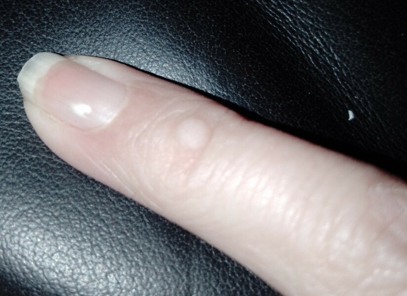 Bump On Finger Bump On Finger