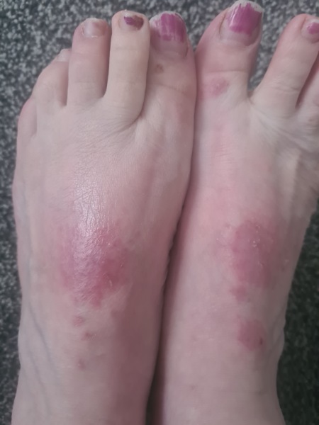 Tops of my feet | Mumsnet