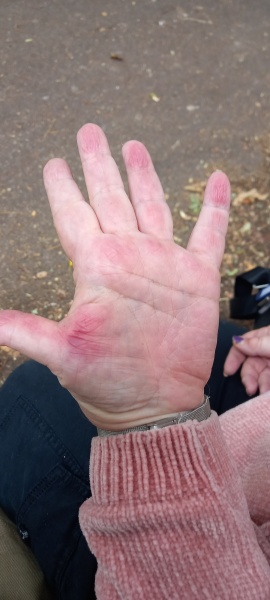 Weird bruise on hand ?! | Mumsnet