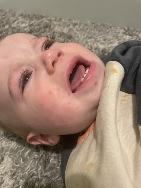 Not sure where to post does this look like chickenpox | Mumsnet