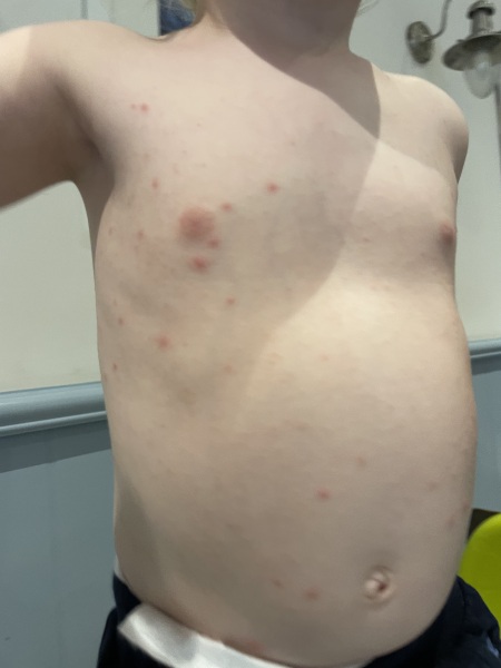 Is this chicken pox and does it always itch | Mumsnet
