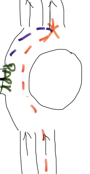 Roundabout collision - who is at fault? With diagram | Mumsnet