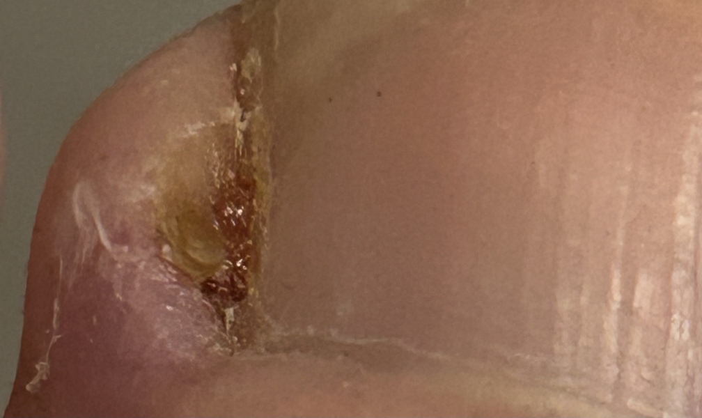 WHAT is going on with my big toe. Warning very Gross pic | Mumsnet