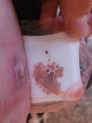 Laparoscopy incision infected? WARNING gross close up | Mumsnet